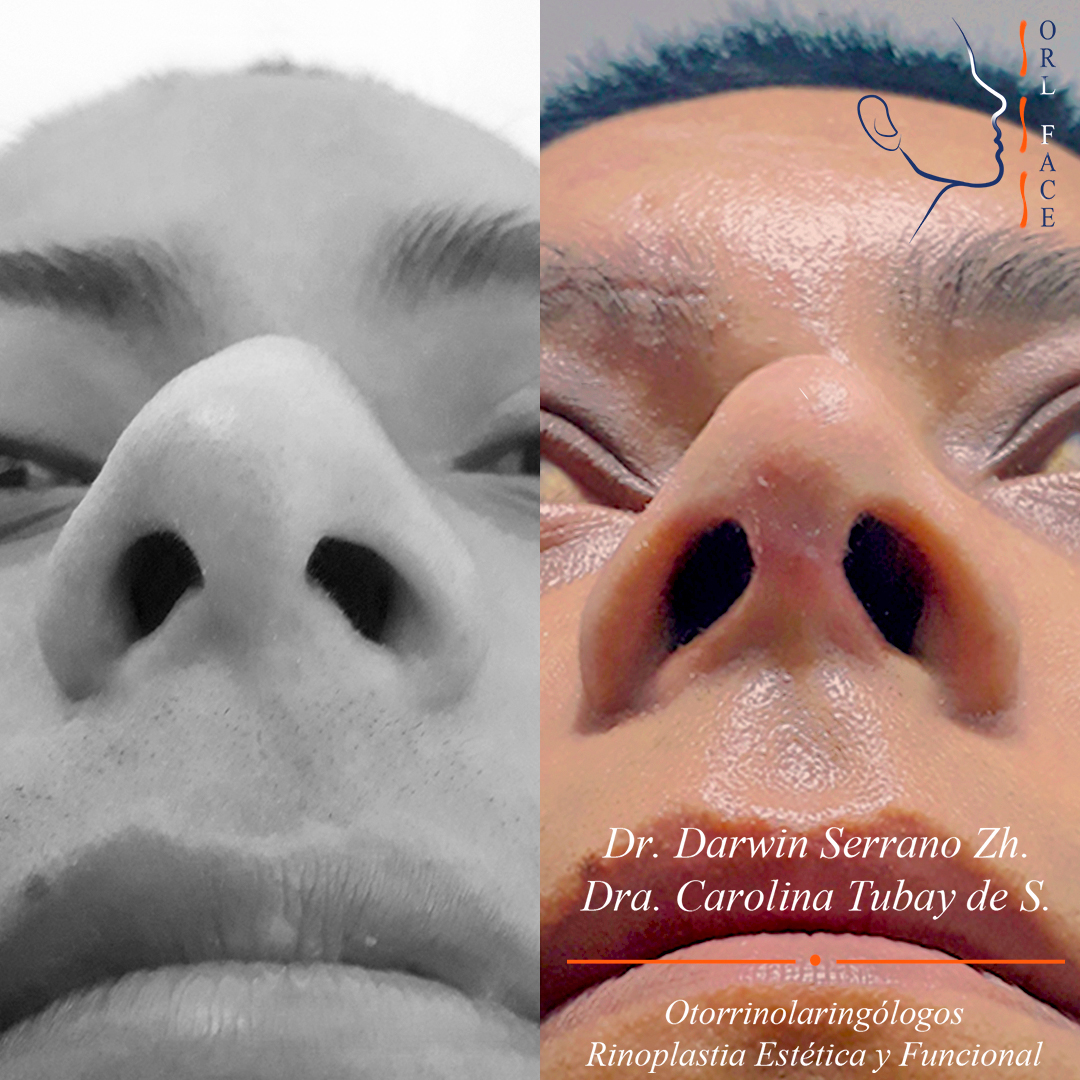 Dr. Serrano & Dra. Tubay. – Otorrinolaringólogos / Cirugía Estética Facial.