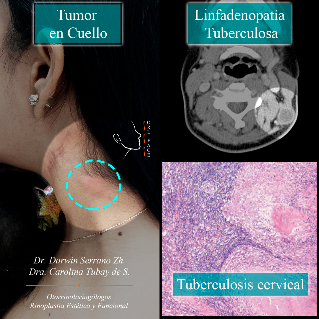 Tuberculosis en Cuello » ORL FACE