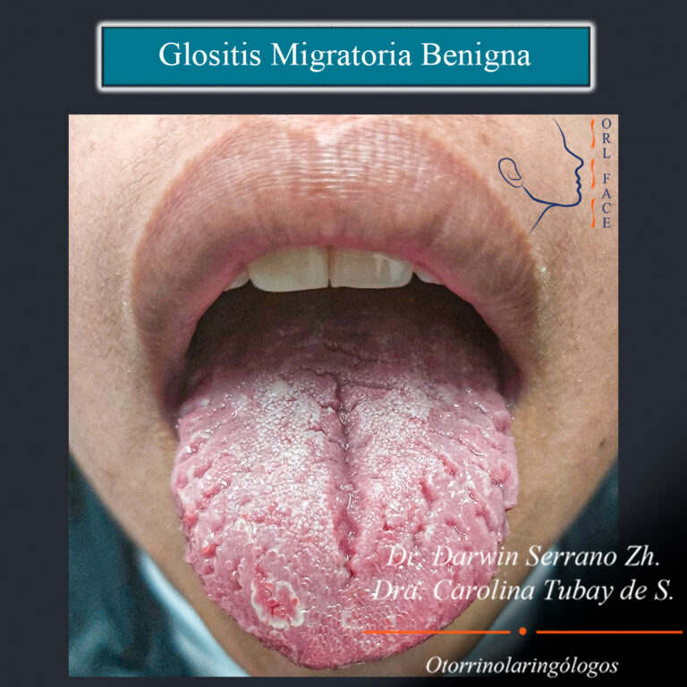 Glositis Migratoria Benigna » ORL FACE