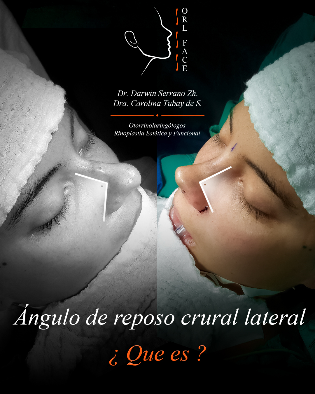 Ángulo de reposo crural lateral » ORL FACE